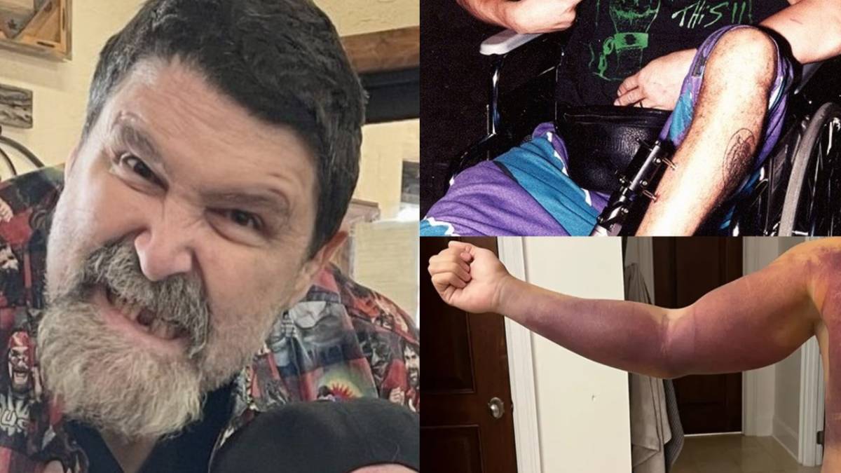 Mick Foley’s Ear & 9 More Visually Shocking Wrestling Injuries